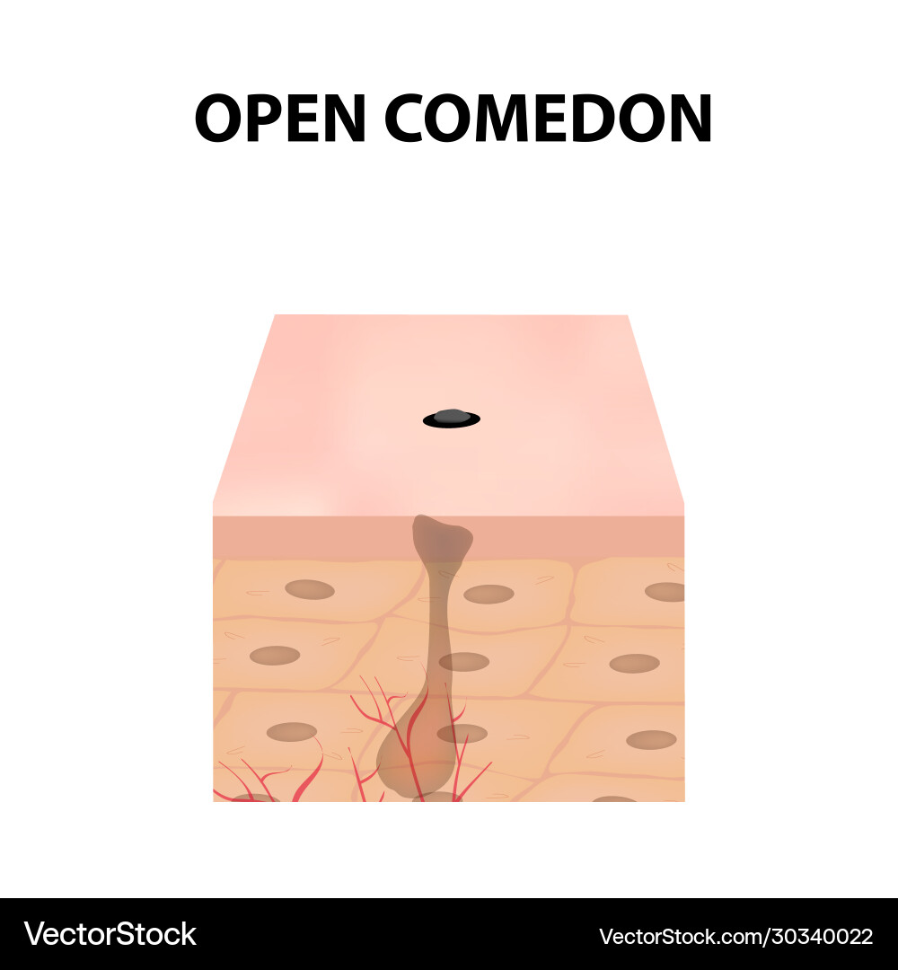 Open comedones acne on skin dermatological Vector Image