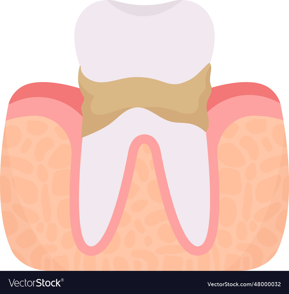 Calculus tooth problem Royalty Free Vector Image