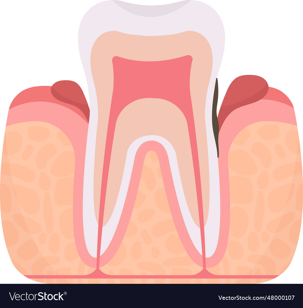 Periodontitis tooth problem Royalty Free Vector Image