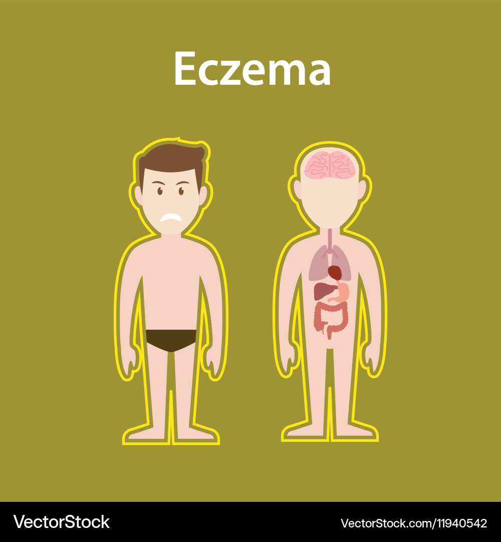 Eczema sick with human body full Royalty Free Vector Image