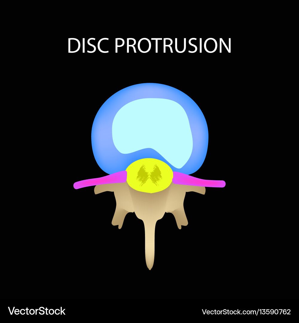 Disc protrusion top view spine infographics Vector Image