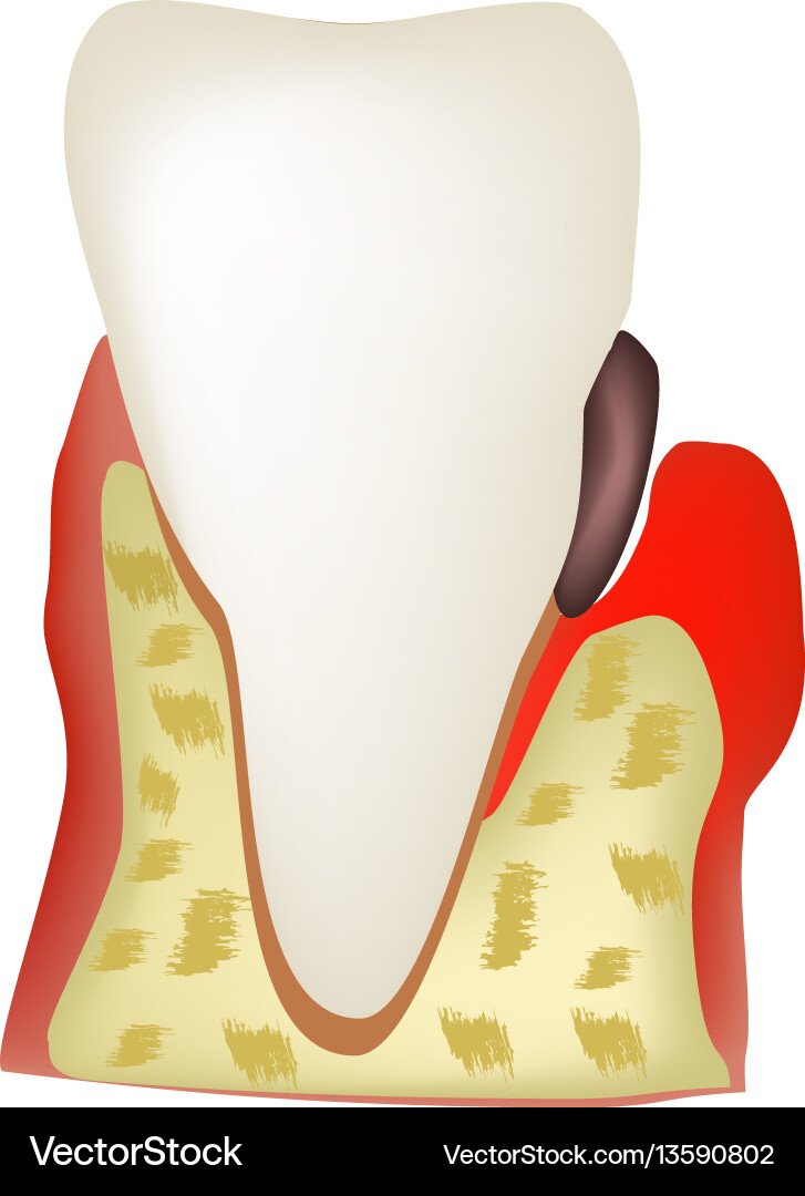 Periodontitis dental disease inflammation Vector Image