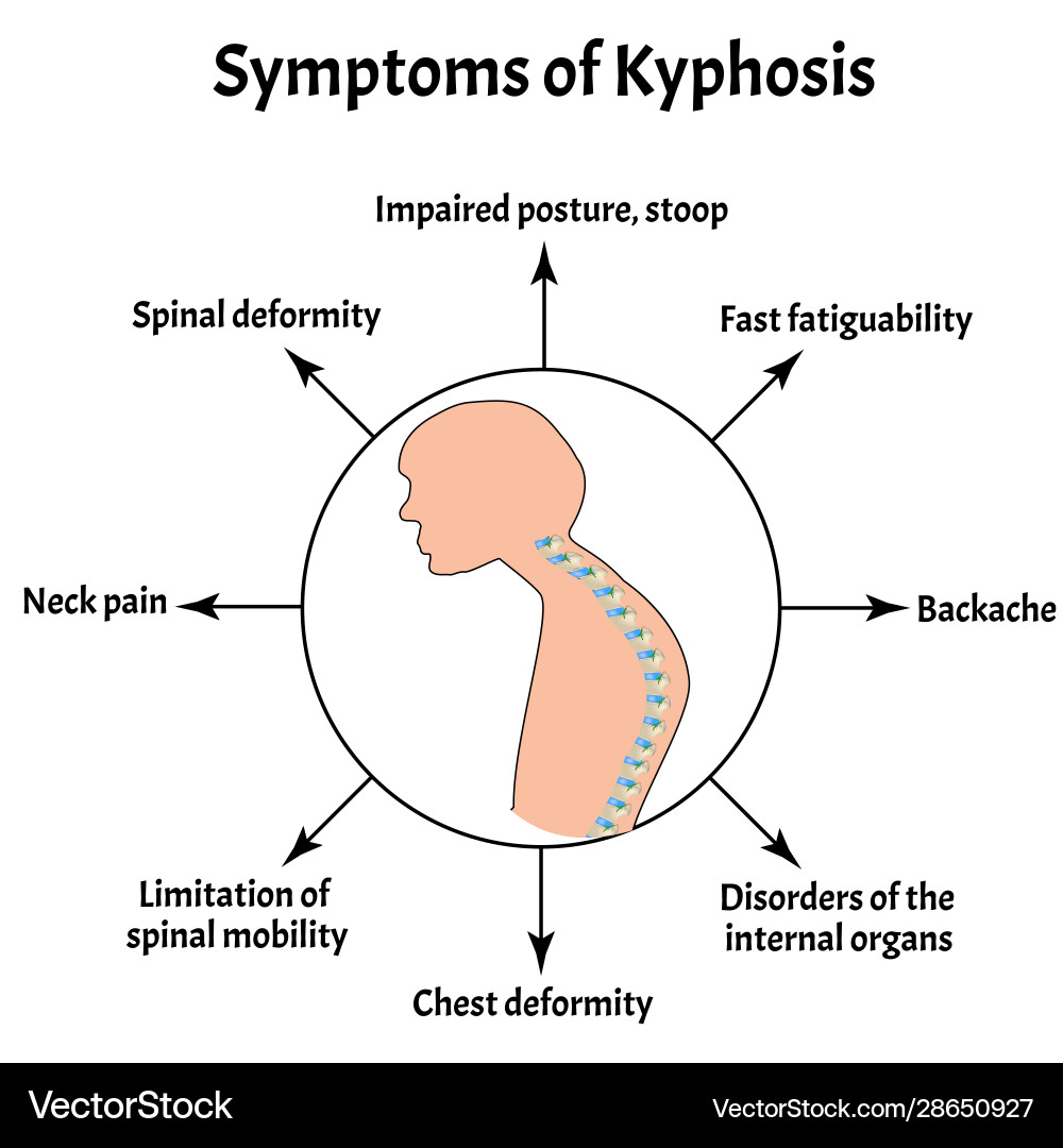 Symptoms kyphosis spinal curvature kyphosis Vector Image