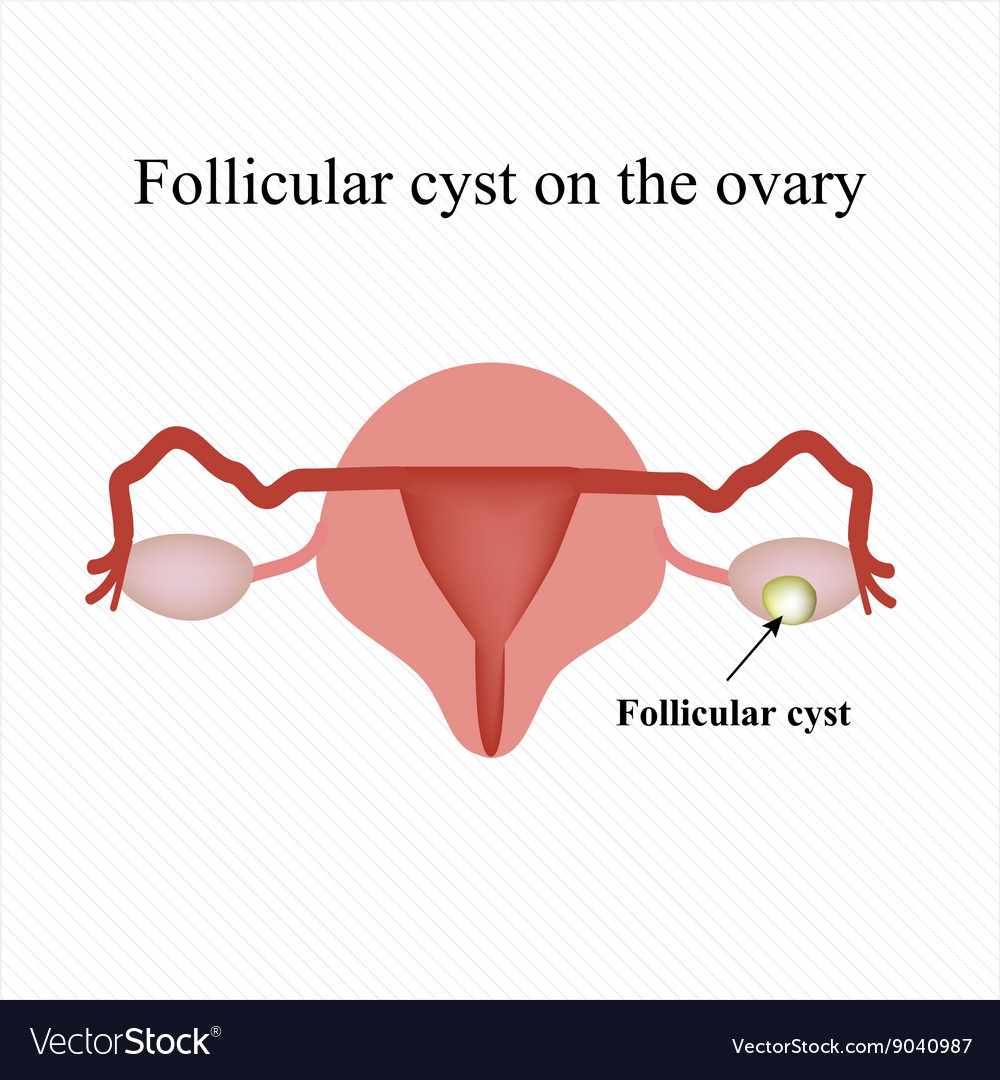 Follicular Ovarian Cyst Functional Royalty Free Vector Image