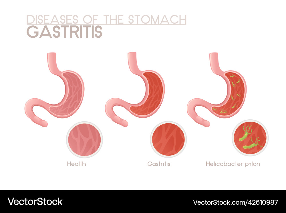 Human stomach with helicobacter pylori Royalty Free Vector