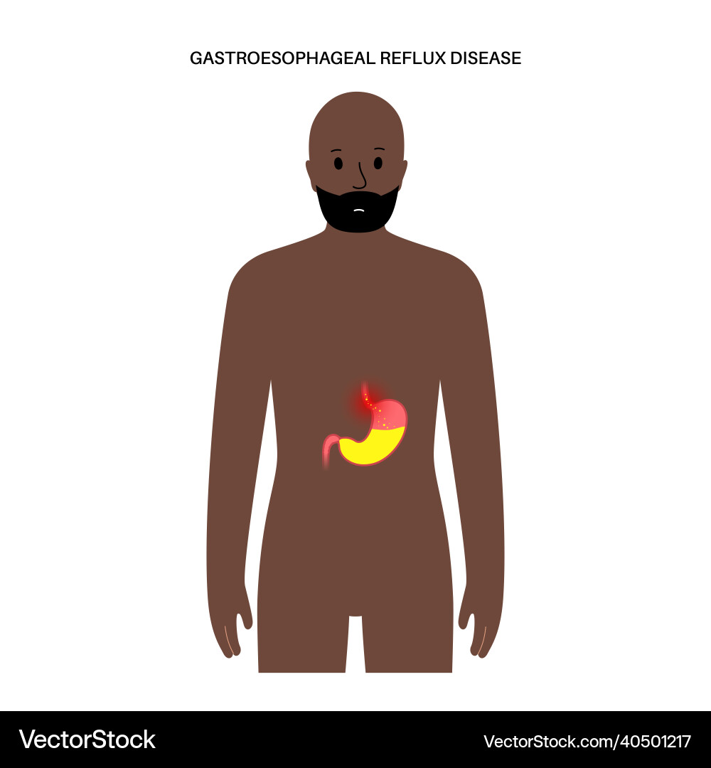 Gastroesophageal reflux disease Royalty Free Vector Image