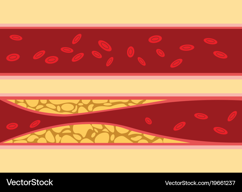 Comparison between normal and unhealthy Royalty Free Vector