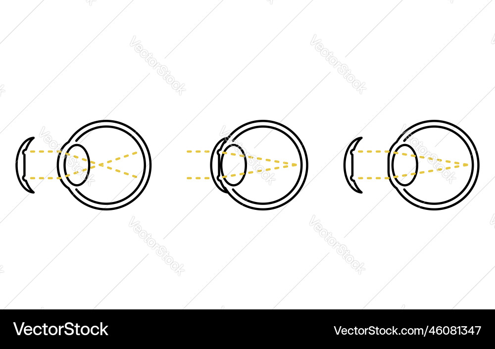 How vision correction lenses and orthokeratology Vector Image