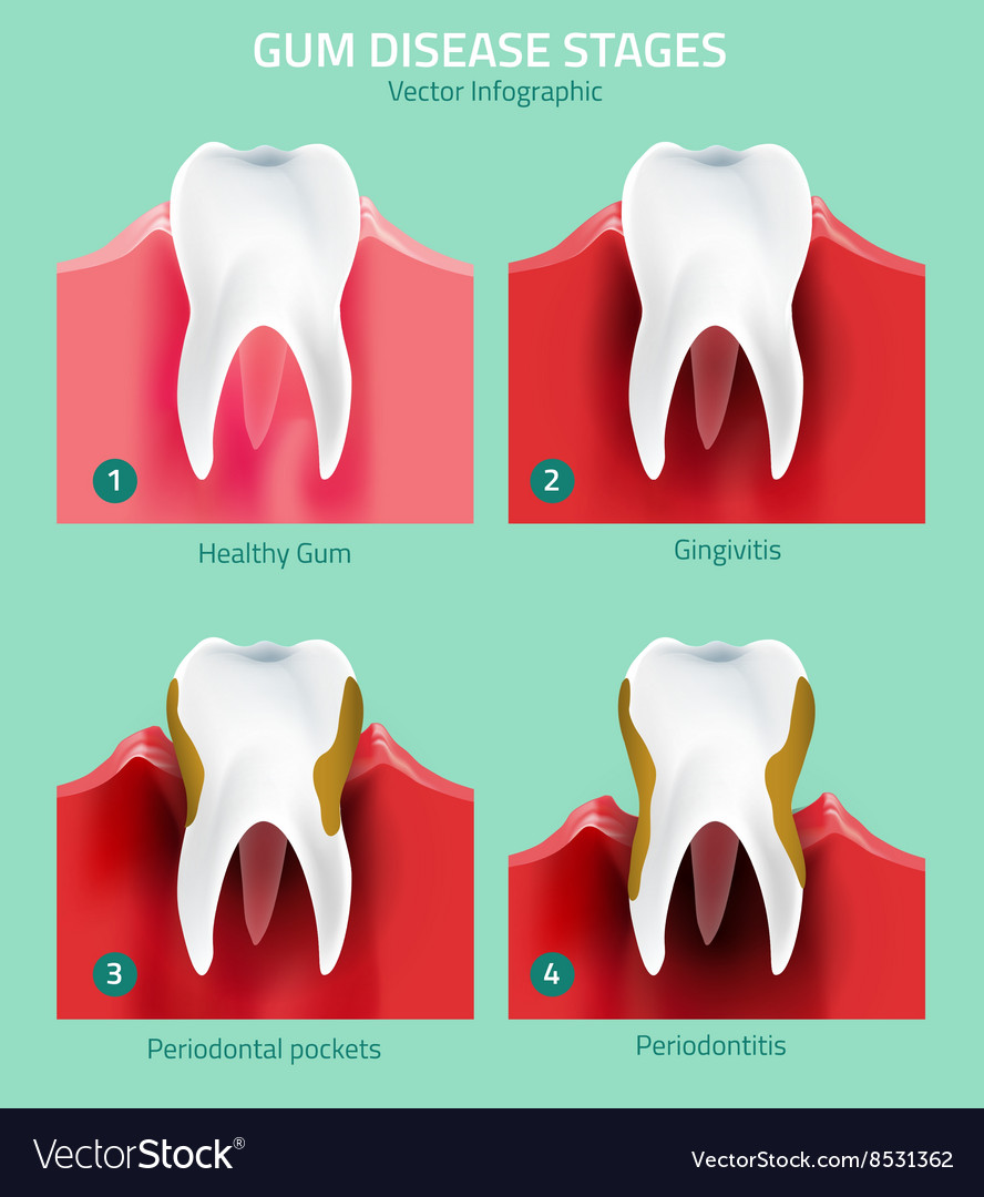 Teeth infographic Royalty Free Vector Image - VectorStock