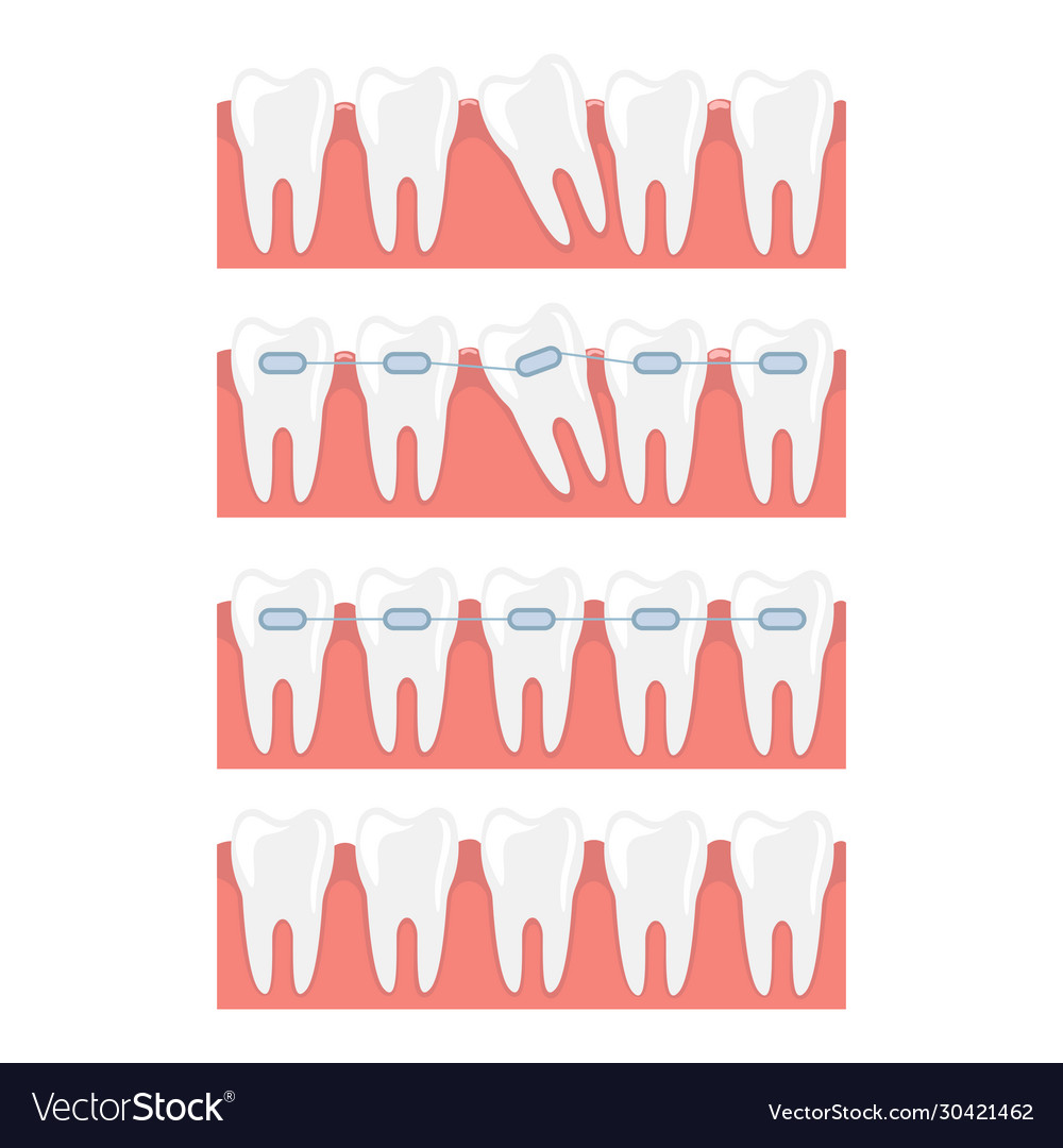Braces set Royalty Free Vector Image - VectorStock Braces set Royalty Free Vector Image - VectorStock