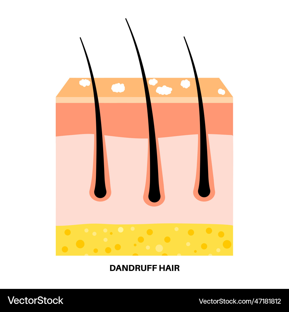 Dandruff Scalp Diagram