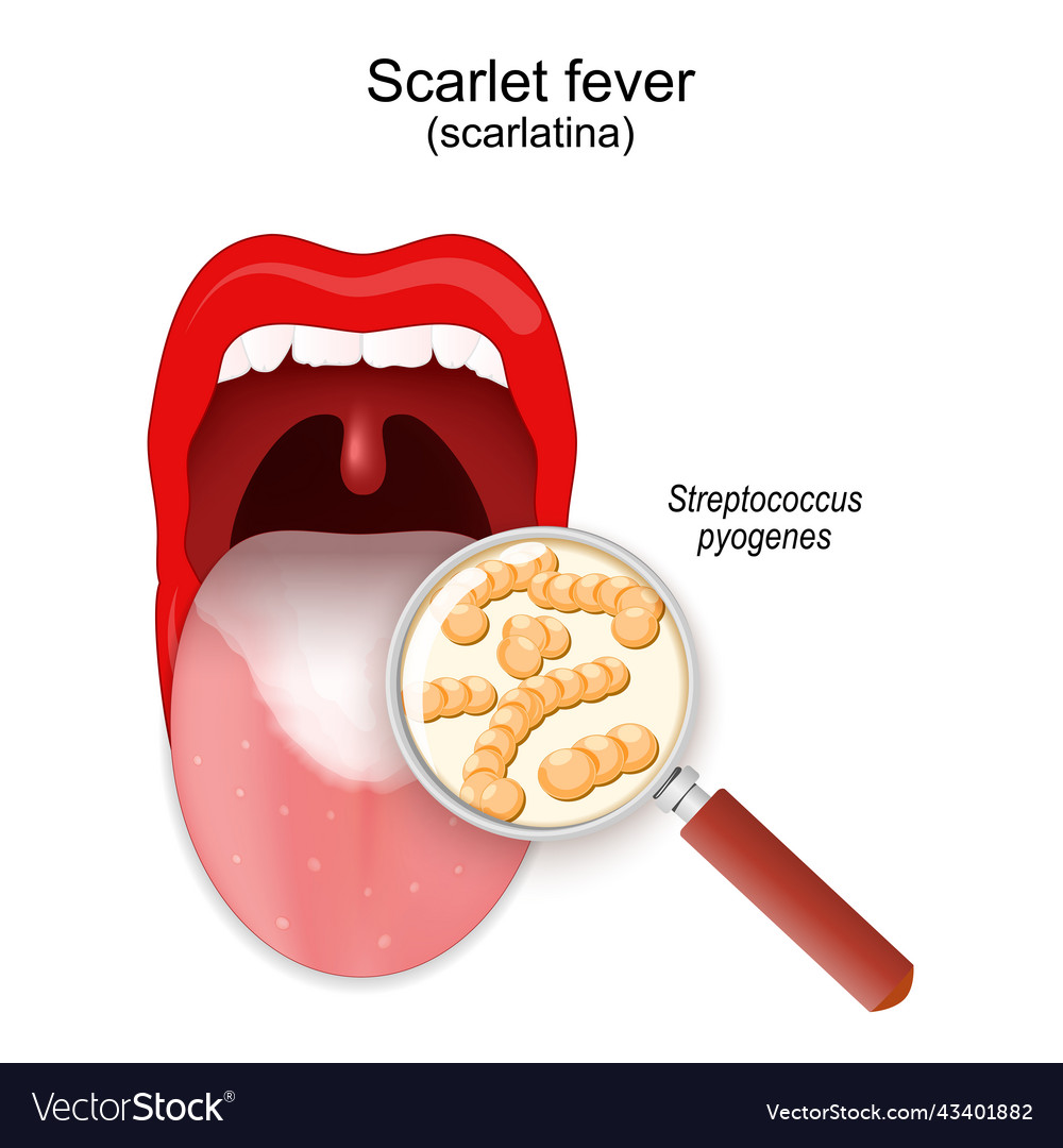 Scarlet Fever Close Up Of Colony Of Streptococcus Vector Image