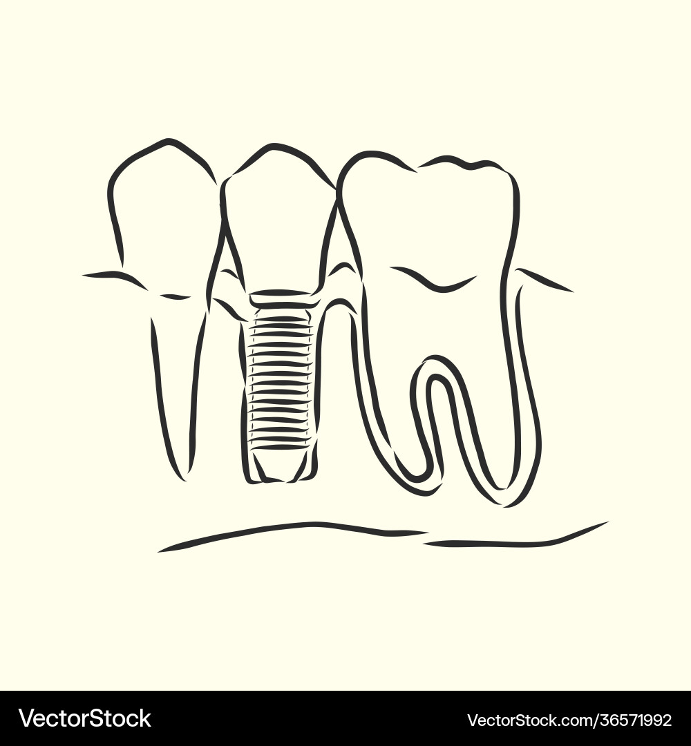 Sketches dental implants implant sketch Royalty Free Vector