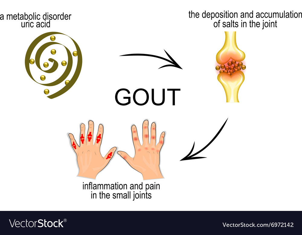 Infographics for disease gout podagra Royalty Free Vector