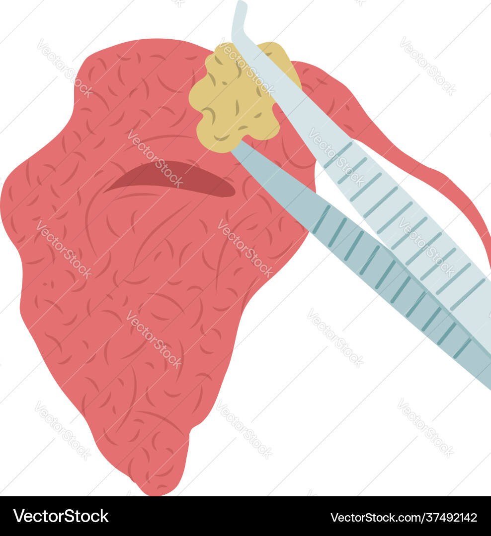 Removing a stone from parotid salivary gland Vector Image