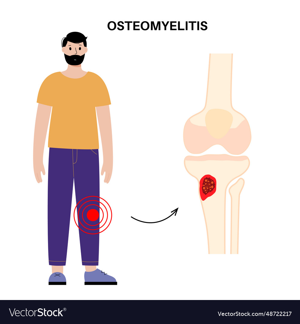Tibia bone osteomyelitis Royalty Free Vector Image