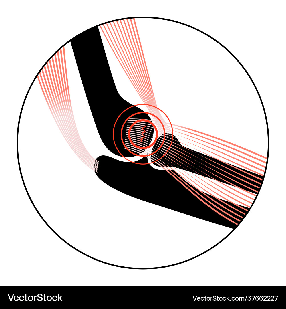 Lateral epicondylitis tennis elbow Royalty Free Vector Image