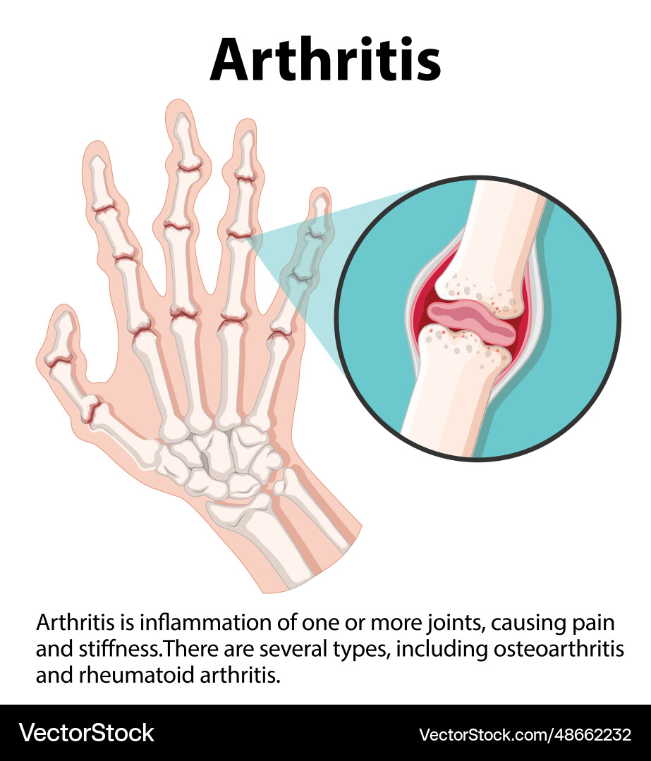 Science education human anatomy and arthritis Vector Image