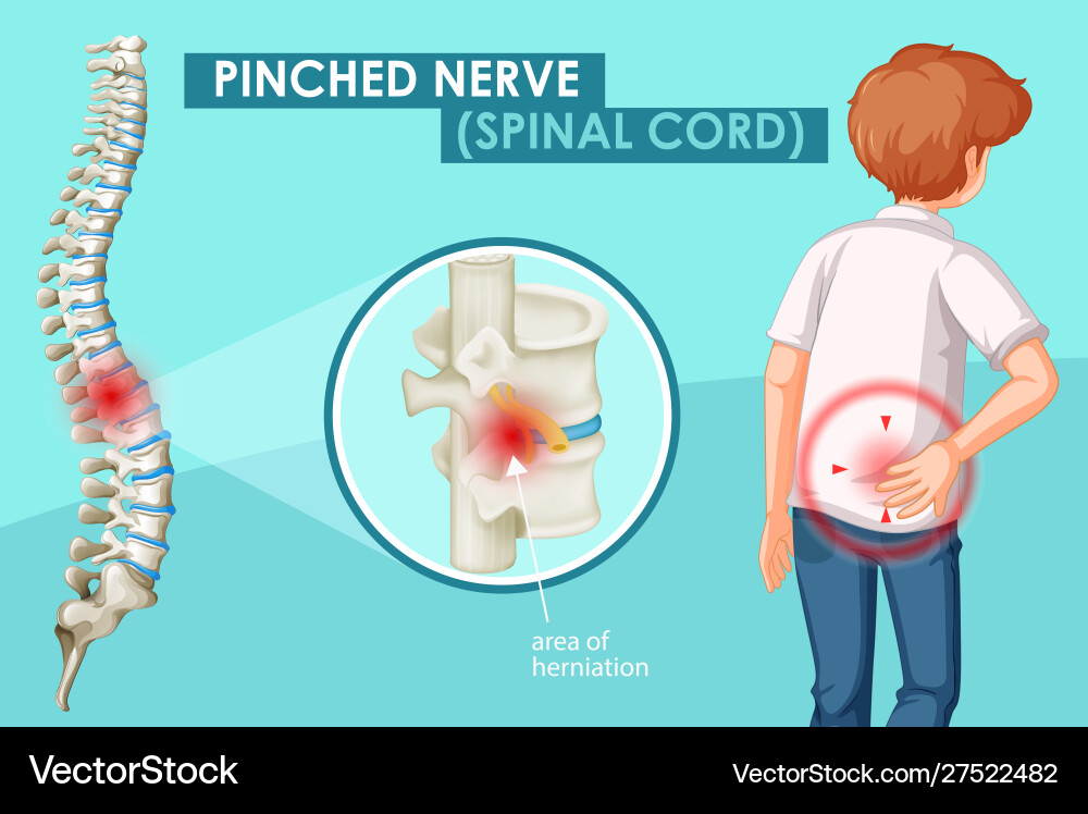 Diagram showing pinched nerve Royalty Free Vector Image