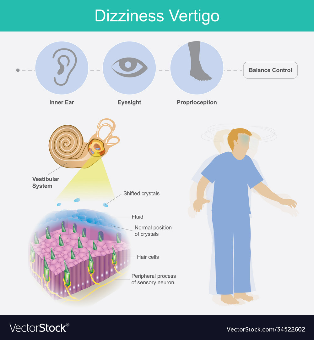 Dizziness vertigo explain Royalty Free Vector Image