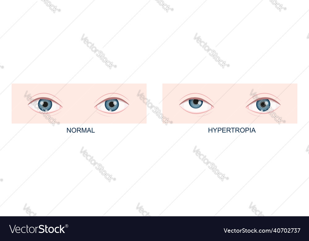 Hypertropia Vertical Strabismus Before And After Vector Image
