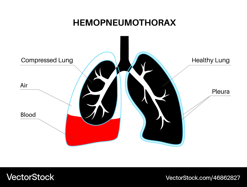 Hemopneumothorax medical poster Royalty Free Vector Image