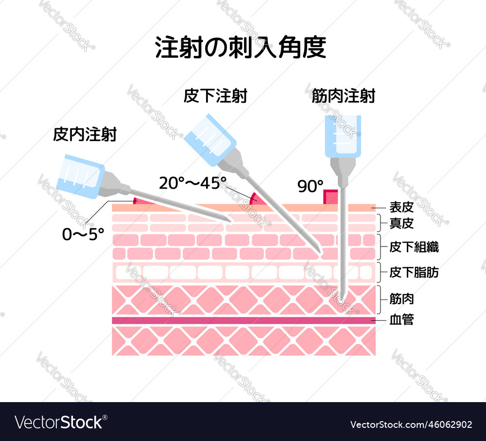 Angles for inserting injections Royalty Free Vector Image