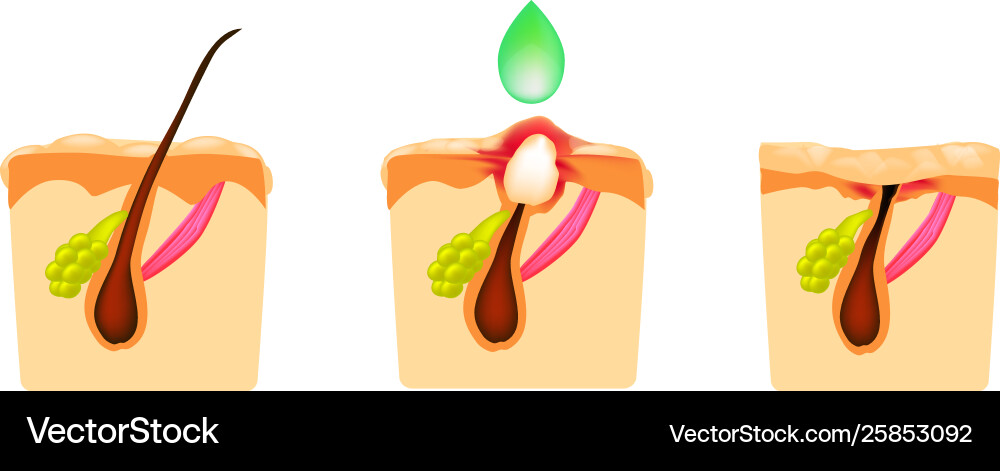 Treatment open comedones inflamed acne Royalty Free Vector
