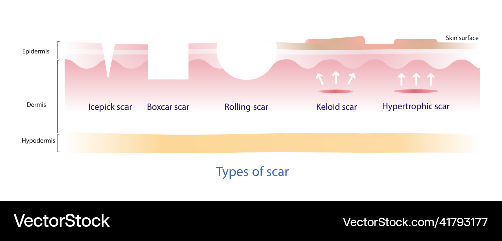 Types of scar on skin surface Royalty Free Vector Image