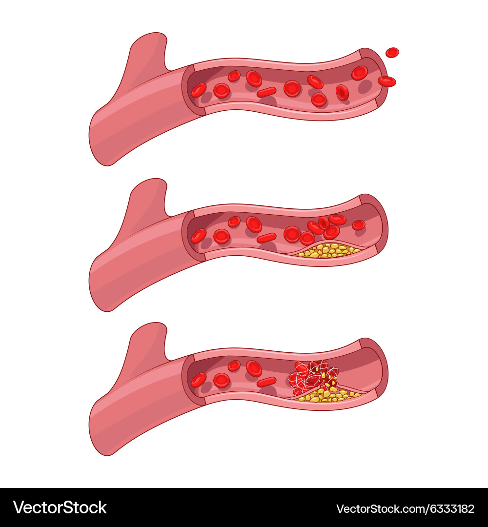 Blood vessel and clot thrombus Royalty Free Vector Image