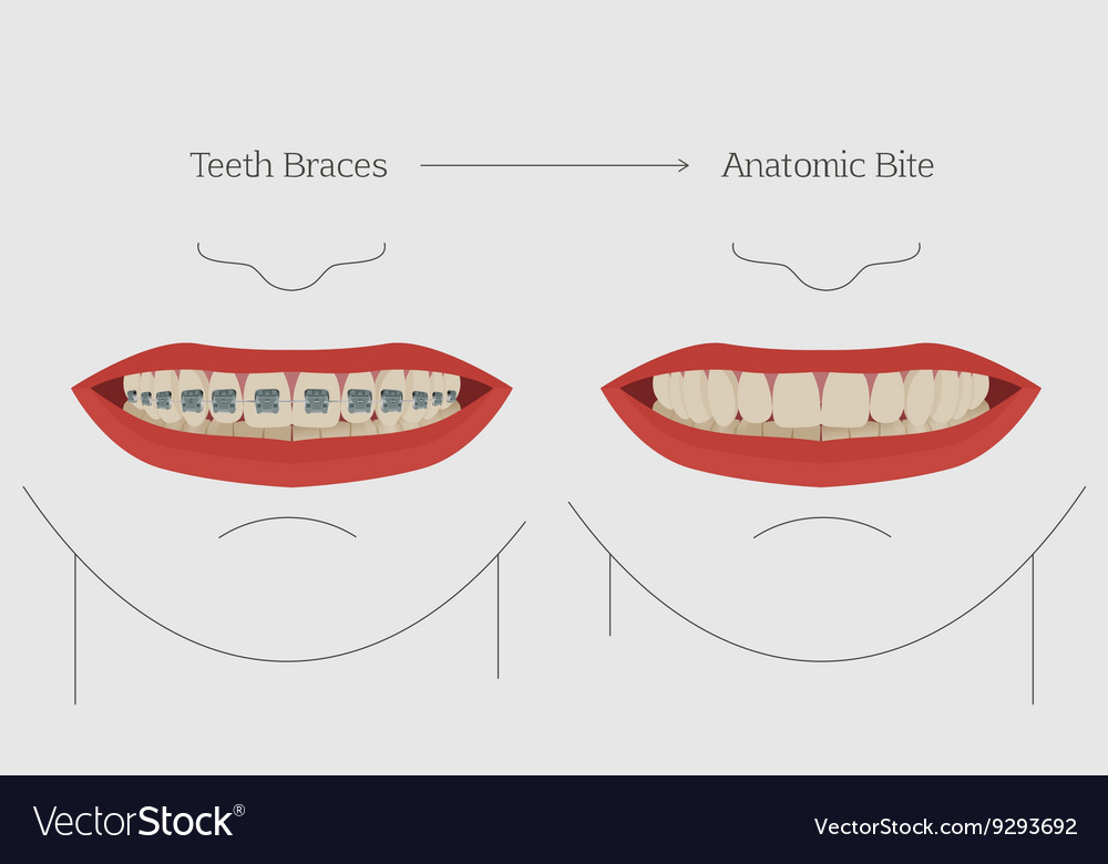 Teeth braces Royalty Free Vector Image - VectorStock