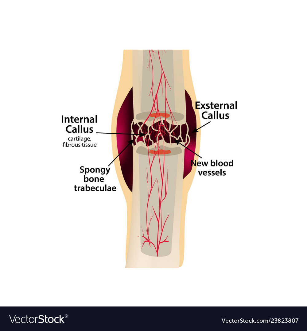 2 stage of healing bone fracture formation Vector Image
