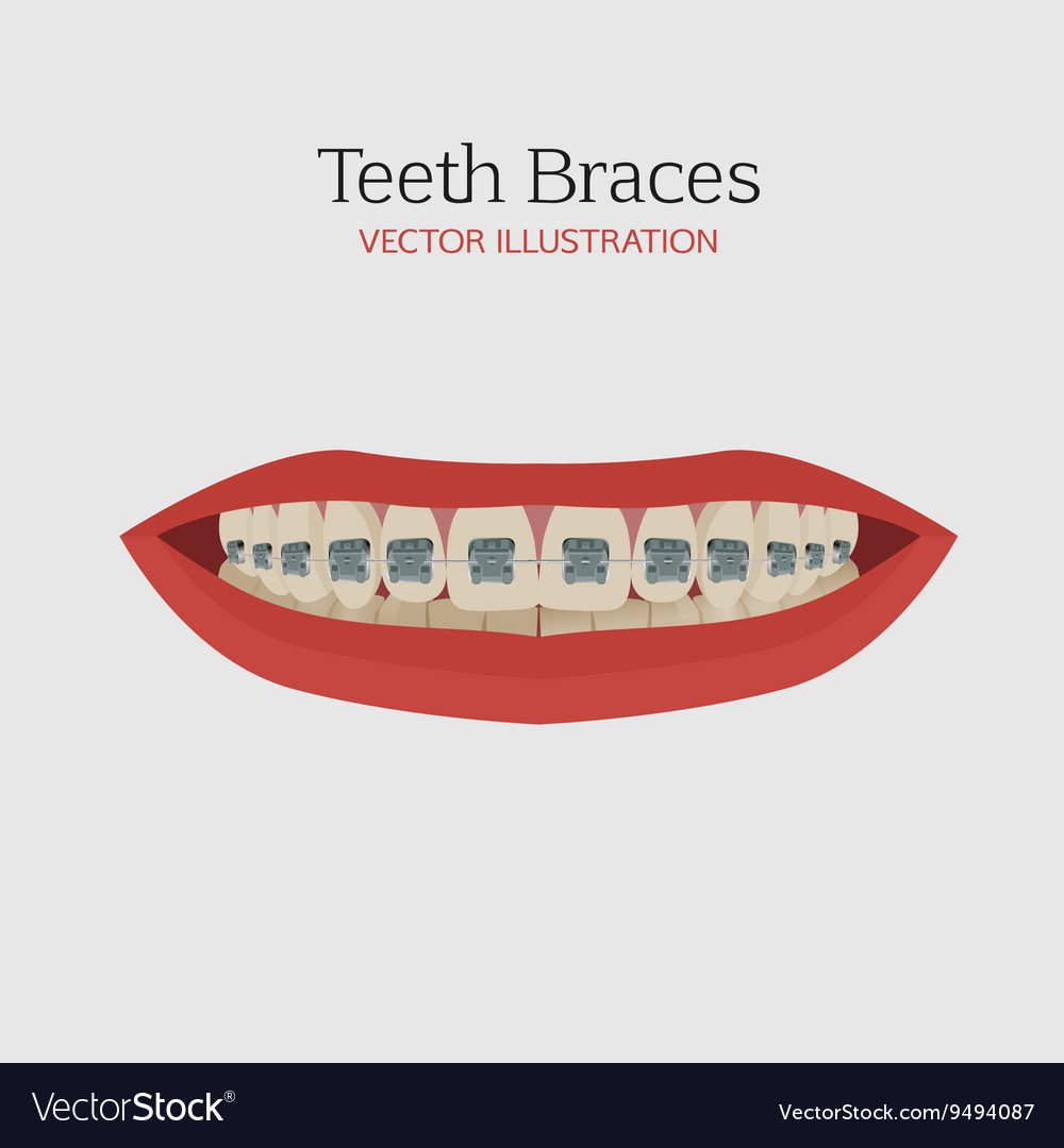 Teeth braces Royalty Free Vector Image - VectorStock