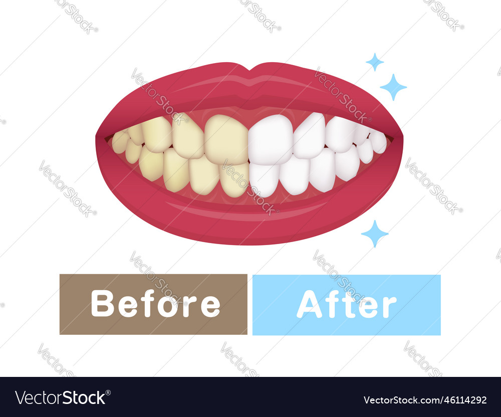 Teeth whitening before and after Royalty Free Vector Image