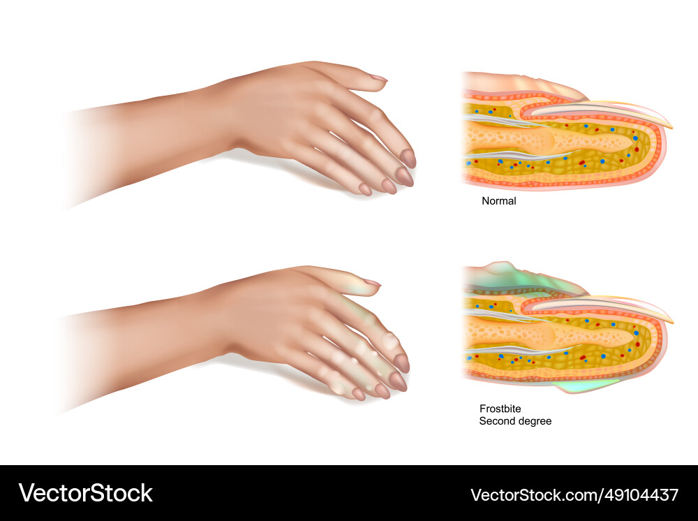 Frostbite second degree skin injury that occurs Vector Image