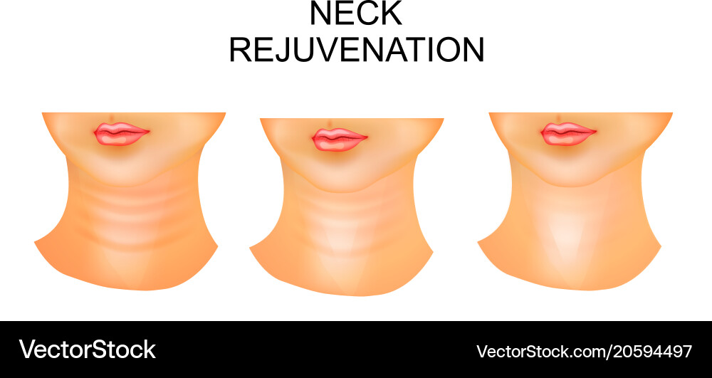 Neck wrinkles rejuvenation Royalty Free Vector Image