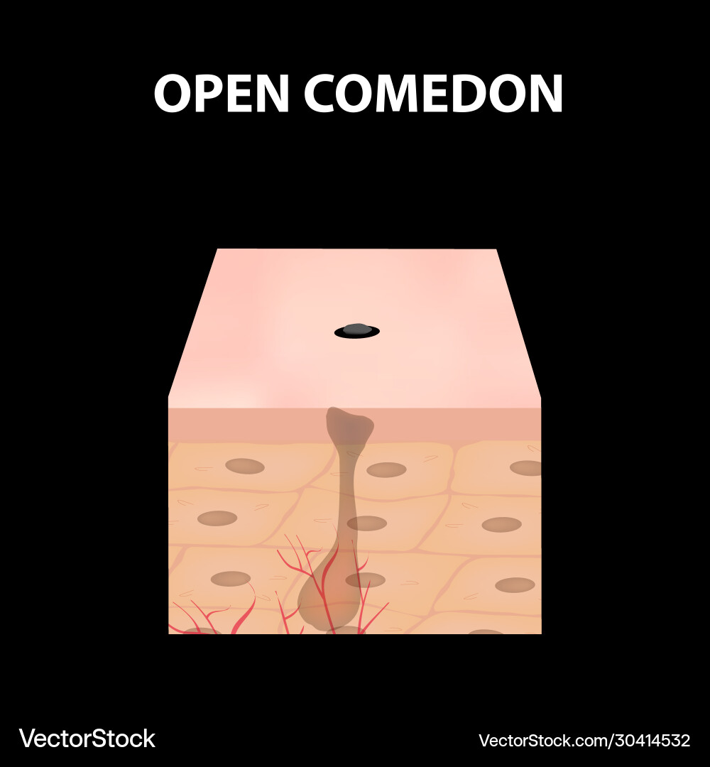 Open comedones acne on skin dermatological Vector Image