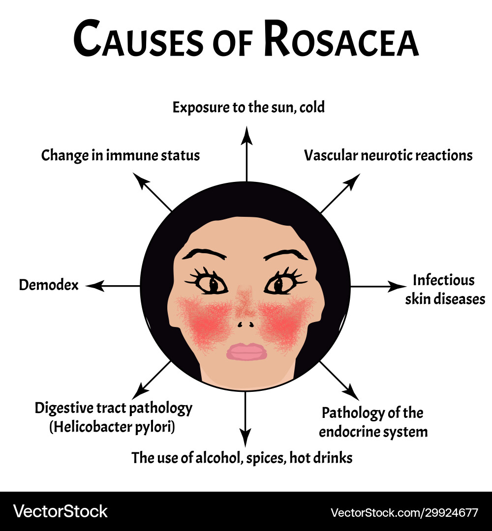 Causes rosacea rosacea awareness month Royalty Free Vector
