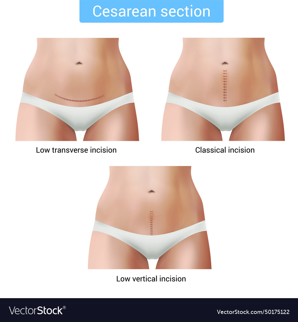 Cesarean section stitches composition Royalty Free Vector