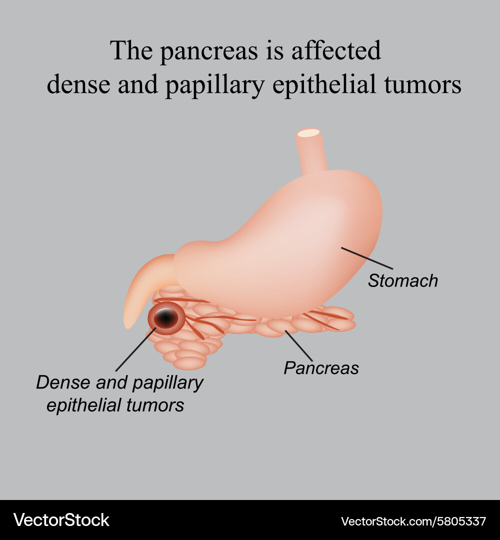 The pancreas is affected dense and papillary Vector Image