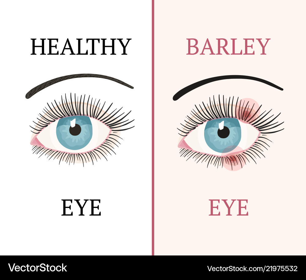 Eye disease ophthalmology health Royalty Free Vector Image