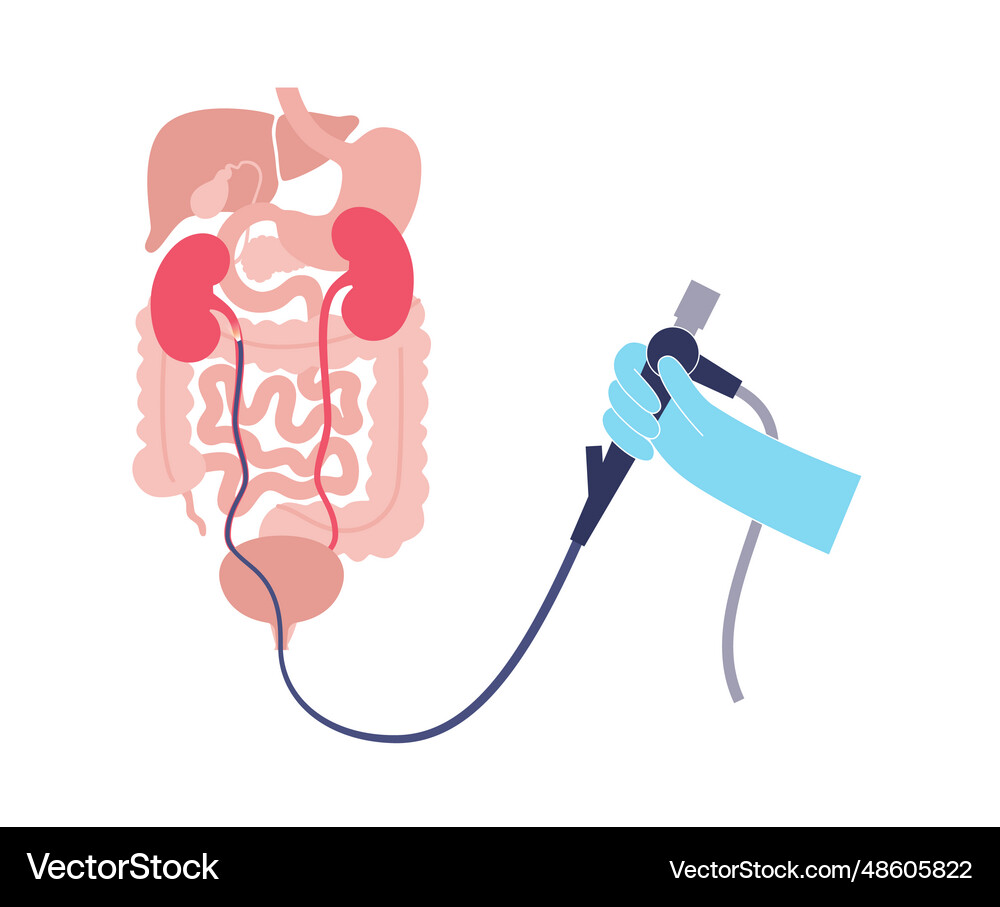 Ureteroscopy medical poster Royalty Free Vector Image