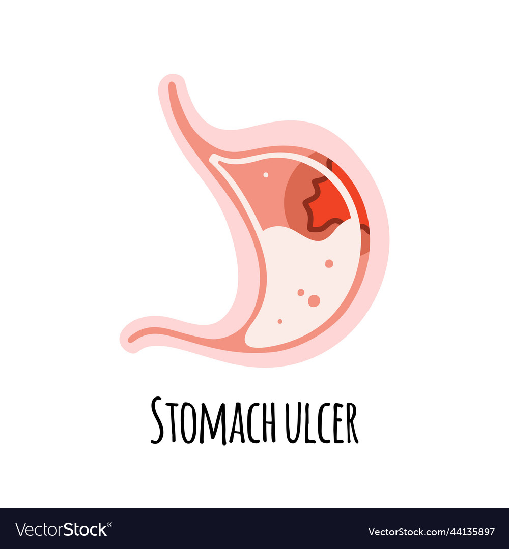 Stomach of a person with an ulcer Royalty Free Vector Image