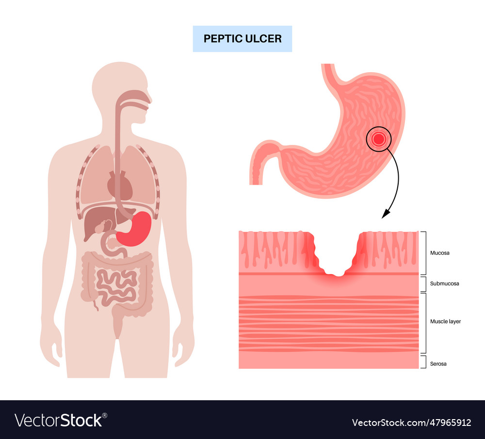 Peptic ulcer disease Royalty Free Vector Image