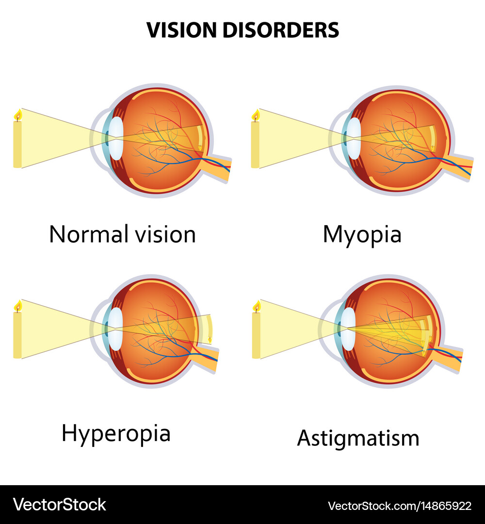 Eye Disorders: Astigmatism, Myopia, Hyperopia Vector Image