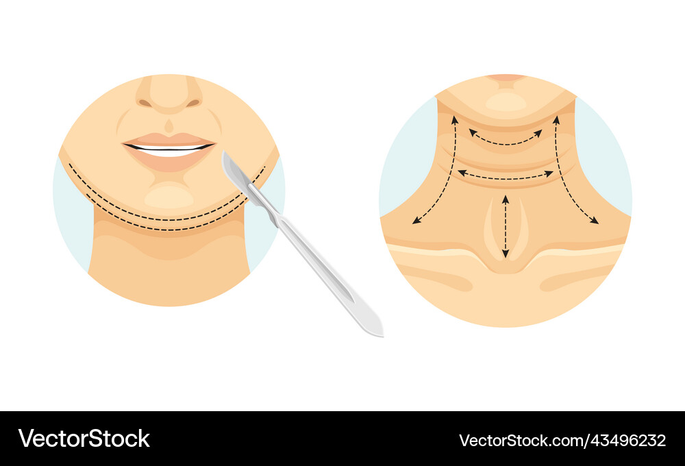 Plastic surgery for chin and neck with stipple Vector Image