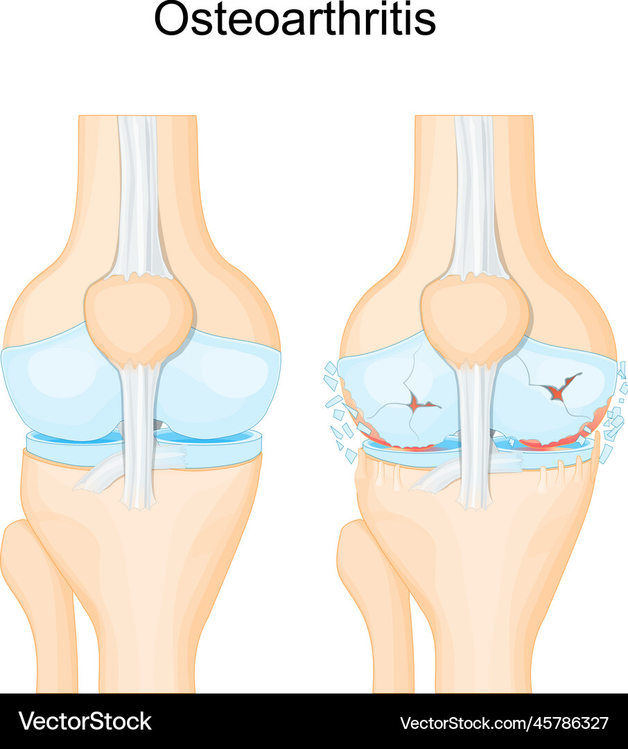 Knee osteoarthritis degenerative joint disease Vector Image