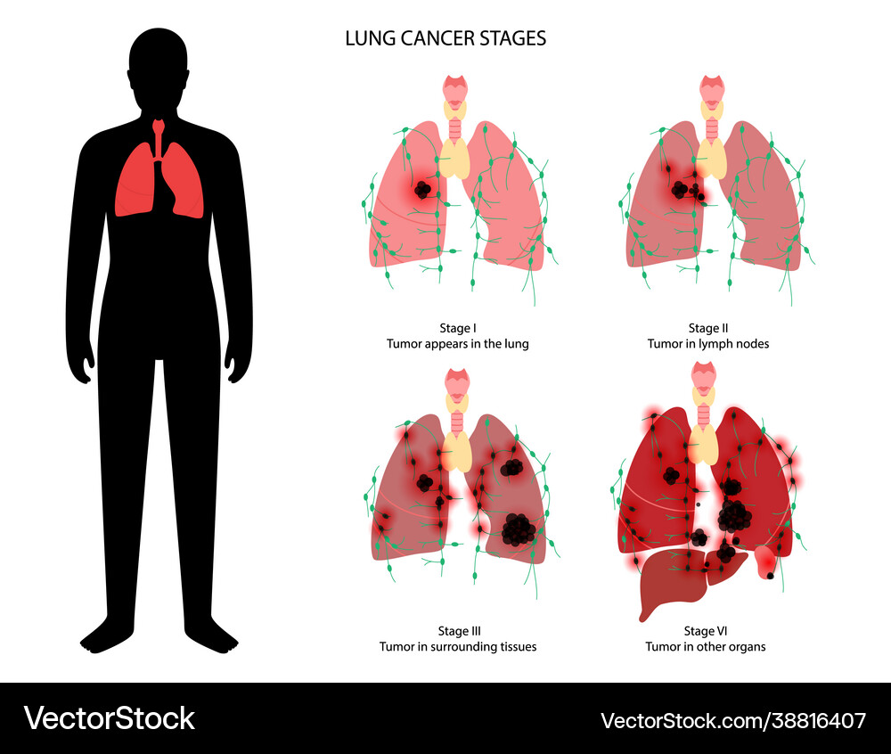 Stages Of Lung Cancer Diagram Trends In Stage I Lung Cancer Clinical