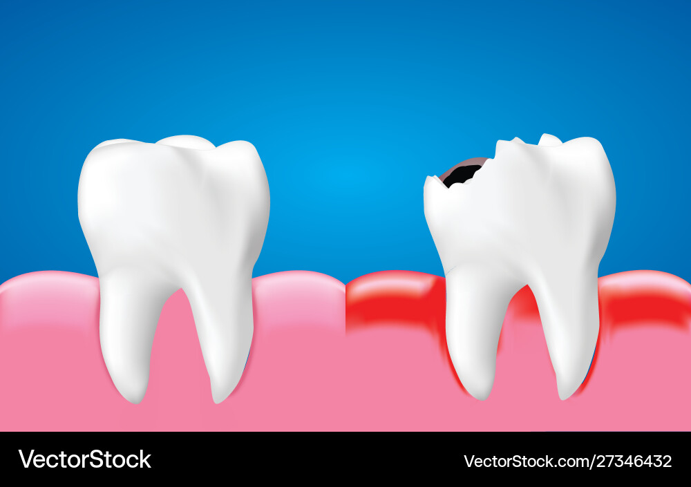 Decay tooth with inflammation and healthy Vector Image