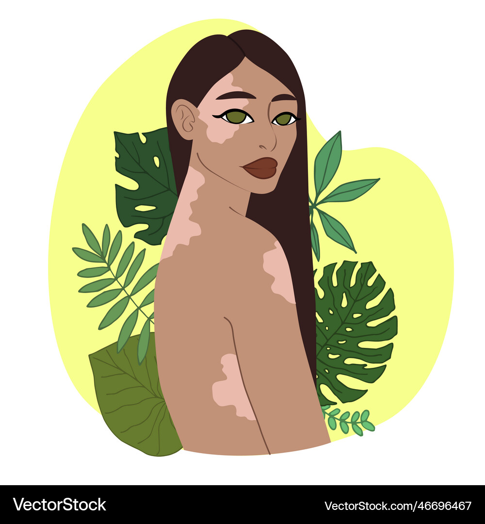 Young woman with vitiligo flat style Royalty Free Vector